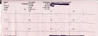 EKG Strips - EMS Artifact