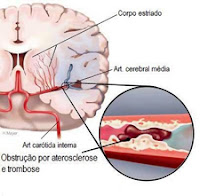 AVC- Acidente Vascular Cerebral | FisioNeuro