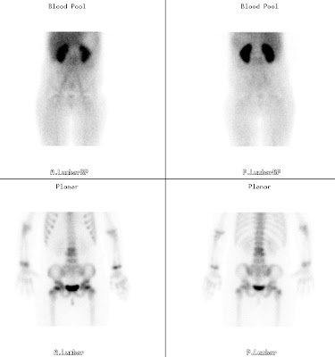 Nuclear Medicine & PET: Bone Scan