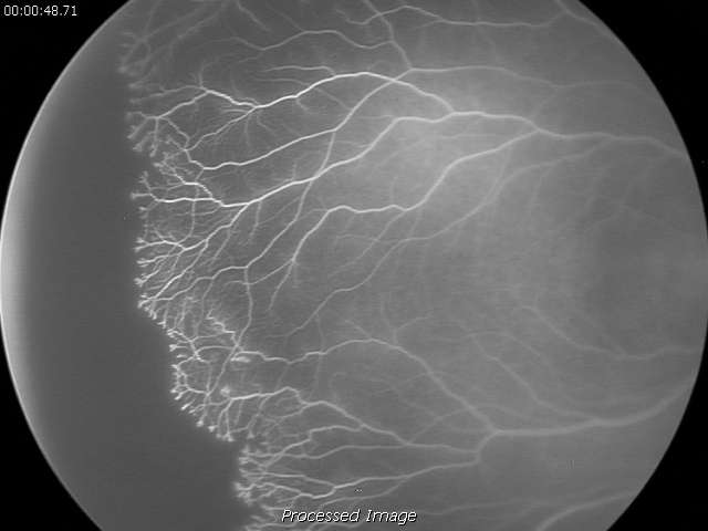 Pediatric Retina: Genetic Testing for Unilateral Persistent ...