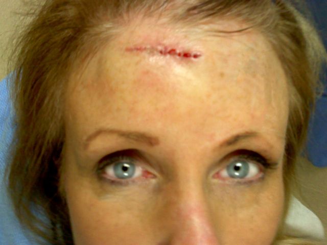 It Was "Couples-Skin-Cancer-Mose-Surgery" Day..... | Murphys Mom