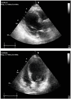 Management of Heart Failure Patients with Preserved Ejection Fraction ...
