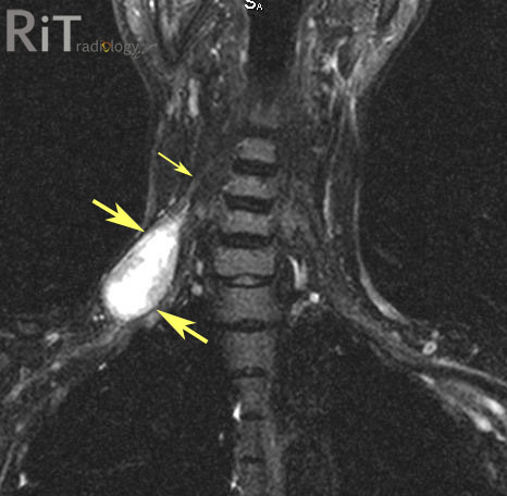 RiT radiology: Primary Brachial Plexus Tumor