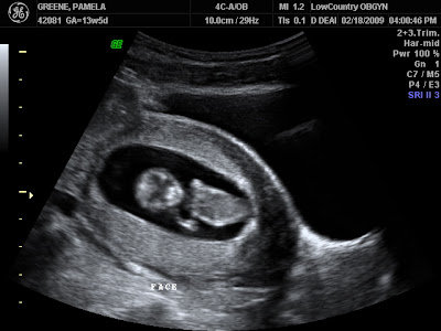 Robert William Greene: 10 weeks 3 day ultrasound