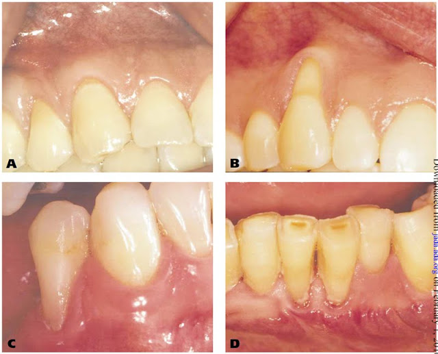 The etiology and prevalence of gingival recession | Perio and Implant ...
