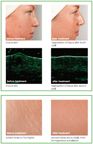 Tessa Darbonne: The Green Peel