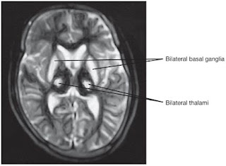 Kathys Mri Pathology Blog Wilsons Disease