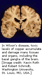 Kathy's MRI Pathology Blog: Wilson's Disease