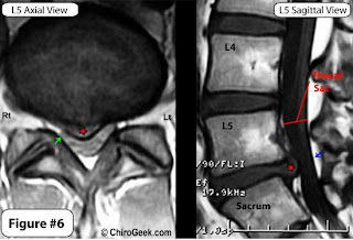 Kathy's MRI Pathology Blog: Herniated and Bulging Disc\Lumbar Spine