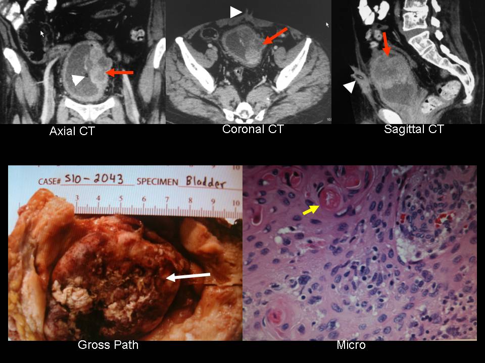 University of Toledo Radiology: Squamous cell carcinoma of the bladder