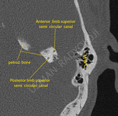 TEMPORAL KEMİK(TEMPORAL BONE) - KAFA TABANI (SKULL BASE) ANATOMİSİ