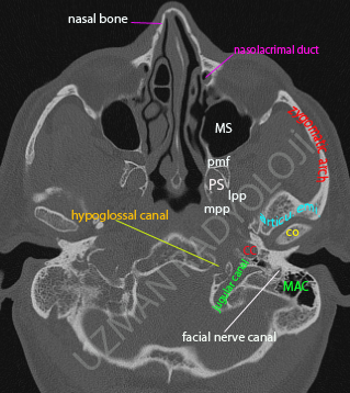 TEMPORAL KEMİK(TEMPORAL BONE) - KAFA TABANI (SKULL BASE) ANATOMİSİ
