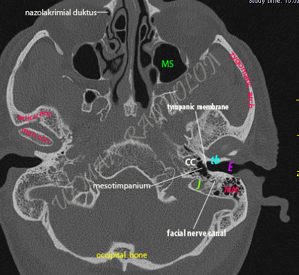 TEMPORAL KEMİK(TEMPORAL BONE) - KAFA TABANI (SKULL BASE) ANATOMİSİ