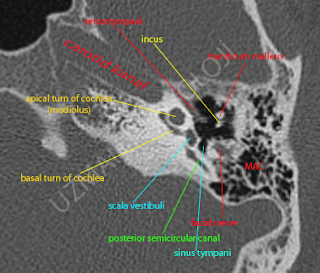 TEMPORAL KEMİK(TEMPORAL BONE) - KAFA TABANI (SKULL BASE) ANATOMİSİ