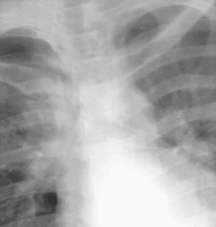 Medstudent Note: 2010.11.04 Critical Care/ ER Chest X Ray Discussion
