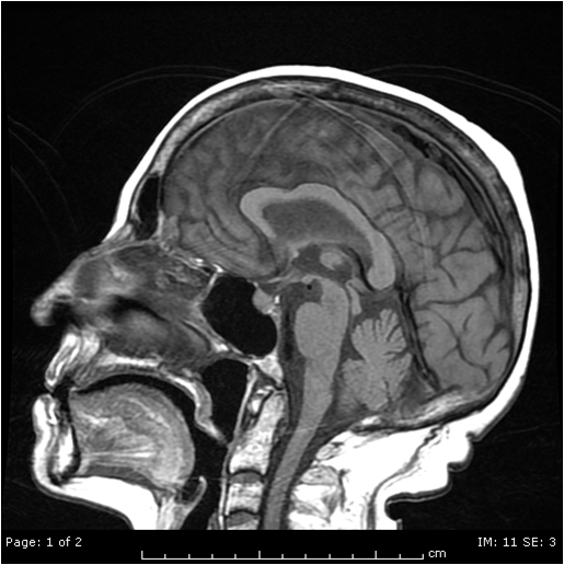 Mindys MRI procedures blog: MRI brain pathology - leptomeningeal ...