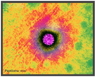 Doenças Sexualmente Transmissíveis: HPV ou Condiloma Acuminado