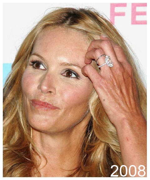 Plastic Surgery Before After: Elle Macpherson Plastic Surgery