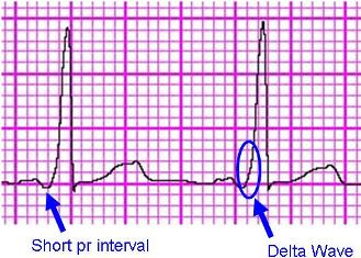 apnathyroid: Short PR in ECG