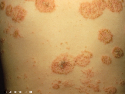 Headache: March 2015