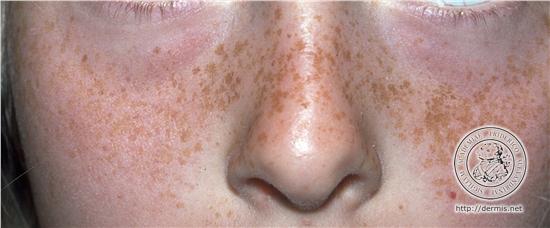 Fisioterapia Dermato - Funcional: Efélides (Sardas)