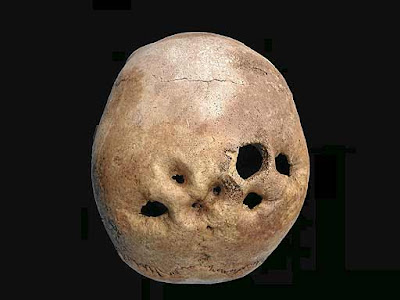 El Chasqui recorre los medios: Sofisticada cirugía cerebral de los Incas