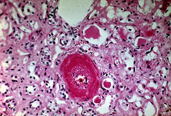 Hypertension: Hypertension