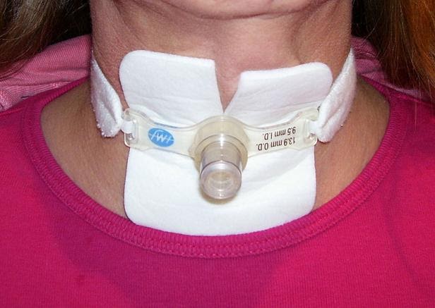 How to perform a tracheostomy