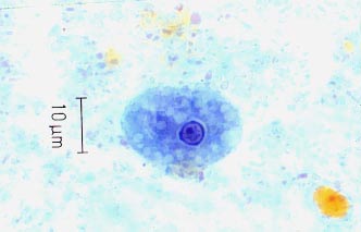 medicine: Entamoeba Coli