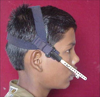 My life attached to a retainer and a secret: The day braces came into ...