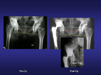 The High Hip Center: THE HIGH HIP CENTER.