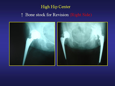 The High Hip Center