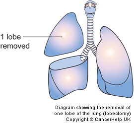 cancer: Cancer Treatment :- Surgery for lung cancer