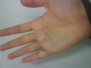 cHeeKaDeS oNLiNe JouRNaL: Swollen Palm