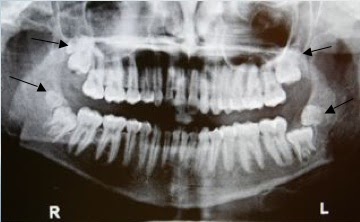 Supernumerary Wisdom Teeth