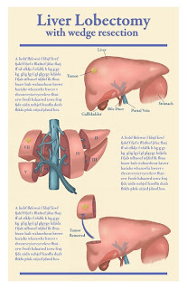 Shannon Allen: Liver Lobectomy...