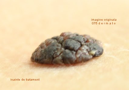 DERMATOLOGIA APROAPE DE TINE CABINET DERMATOLOGIE IASI DERMATOLOG: NEV ...