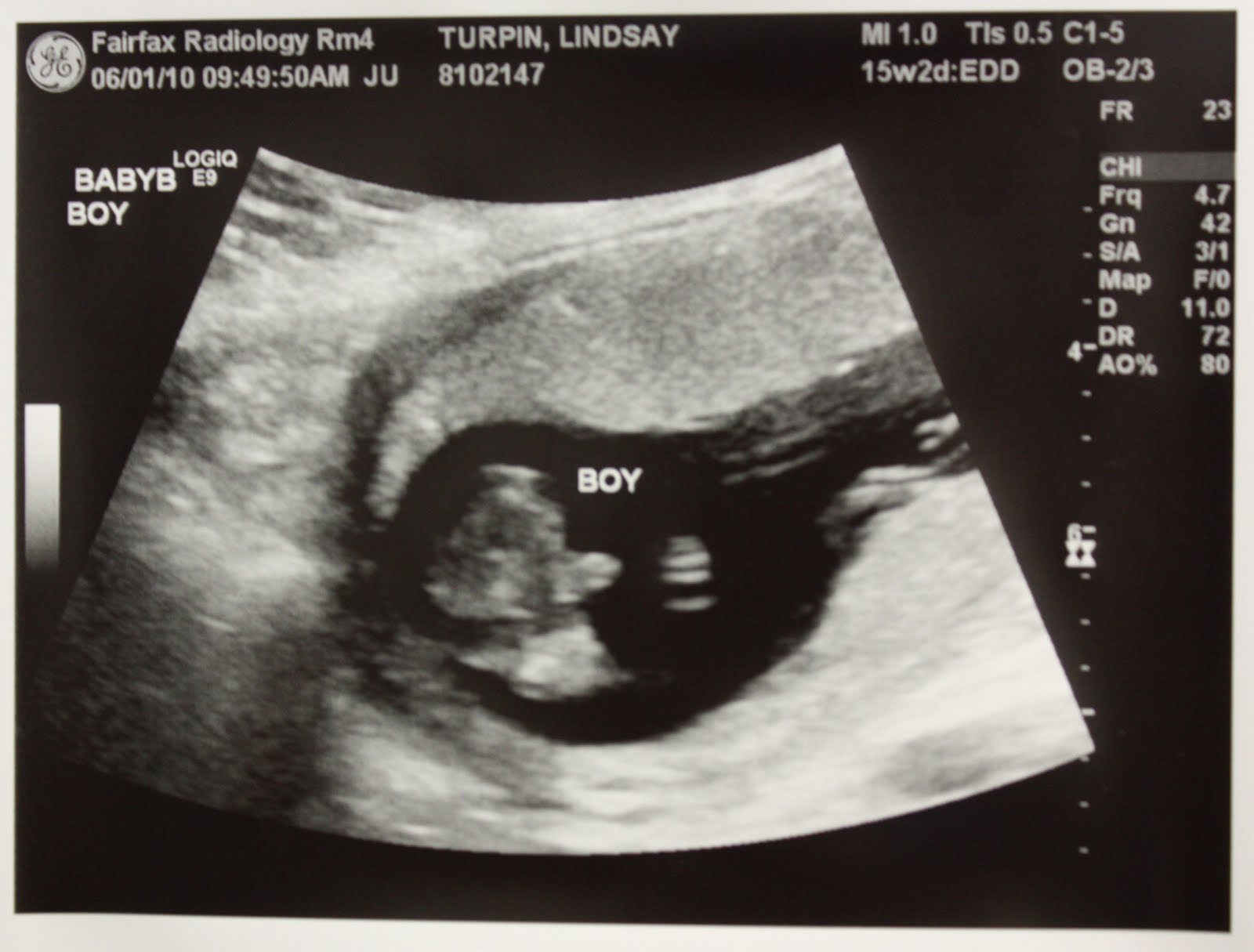 Baby Boy Ultrasound At 14 Weeks