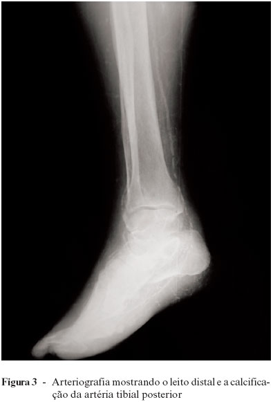 Patologia Fácil: Calcificação Patológica