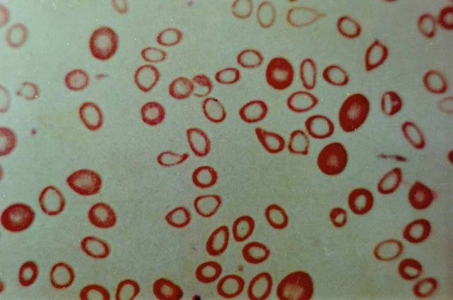 Patologia Fácil: Anemia ferropriva