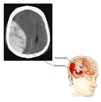 Patologia Fácil: HEMORRAGIA SUBARACNÓIDE(HSA)