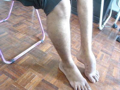 Education of a Knife: Polio