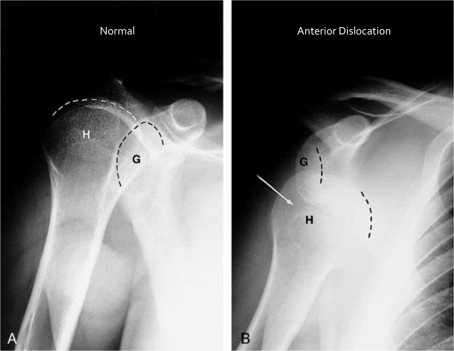Physio Questions: Shoulder Complex (Part III) - Anterior/Posterior ...