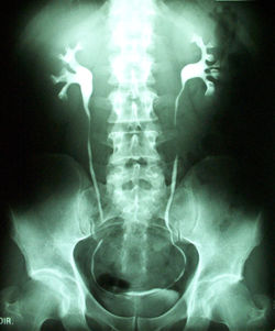 Eu sou + Radiologia.: Urografia Excretora - Urografia Intravenosa!