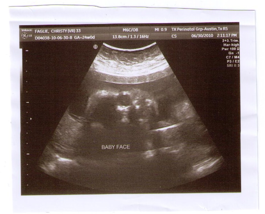 One Day At A Time: Baby Girl ultrasound 24 weeks