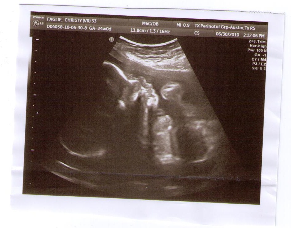 One Day At A Time: Baby Girl ultrasound 24 weeks