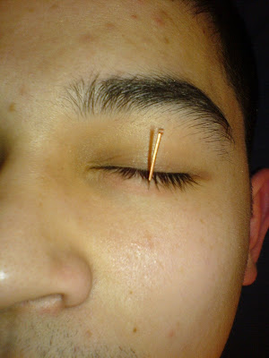 Chinese Medicine Adventures with Damien Bodnarchuk: Acupuncture in the ...