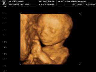The Nichols Family: 3d/4d Ultrasound 22 Weeks!