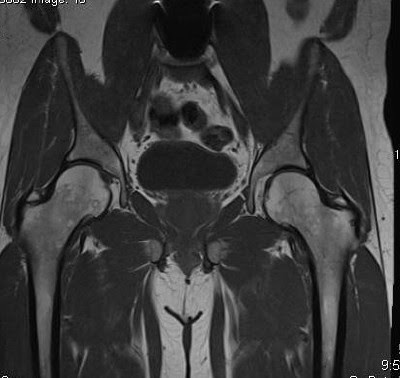 Hip joint MRI: MRI