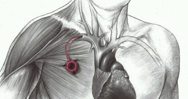 The Journey: Biopsy and Port-A-Cath Udpate